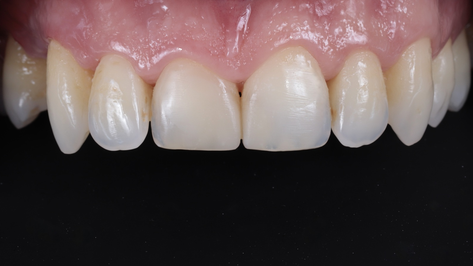 Lograr la simetría perfecta: restauración de incisivos centrales