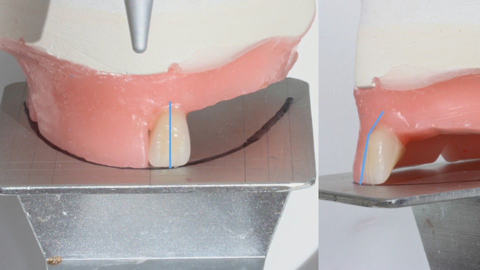 Caso Clínico: Montaje de dientes para prótesis completa