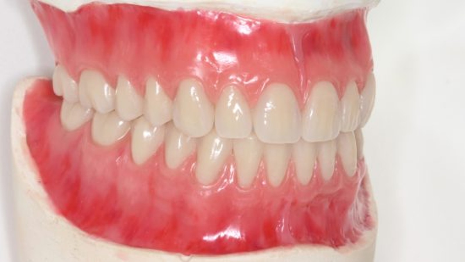 Caso Clínico: Montaje de dientes para prótesis completa