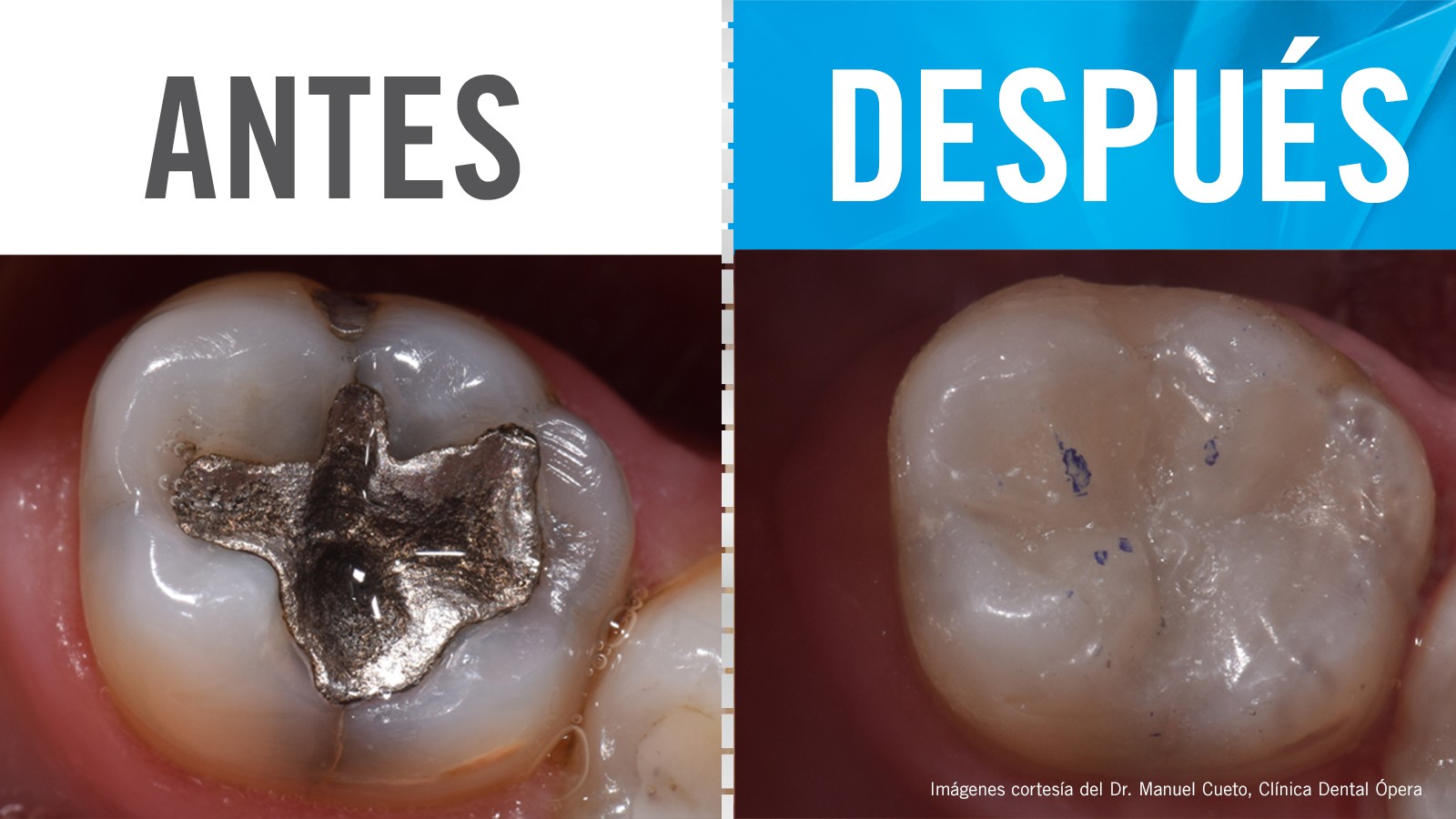 Caso Clínico: Sustitución de una restauración de amalgama por Ven